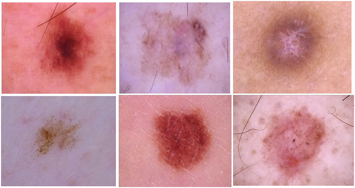 New method enables more reliable skin cancer detection by automatically ...